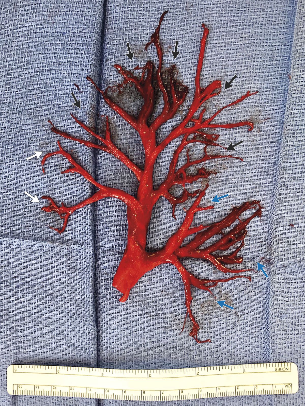 One Foot Tsunami: Tree of Blood